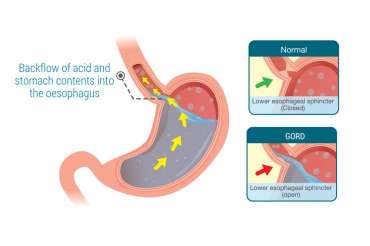 Gastroesophageal Reflux Disease (GORD) - MR YAHYA AL-HABBAL